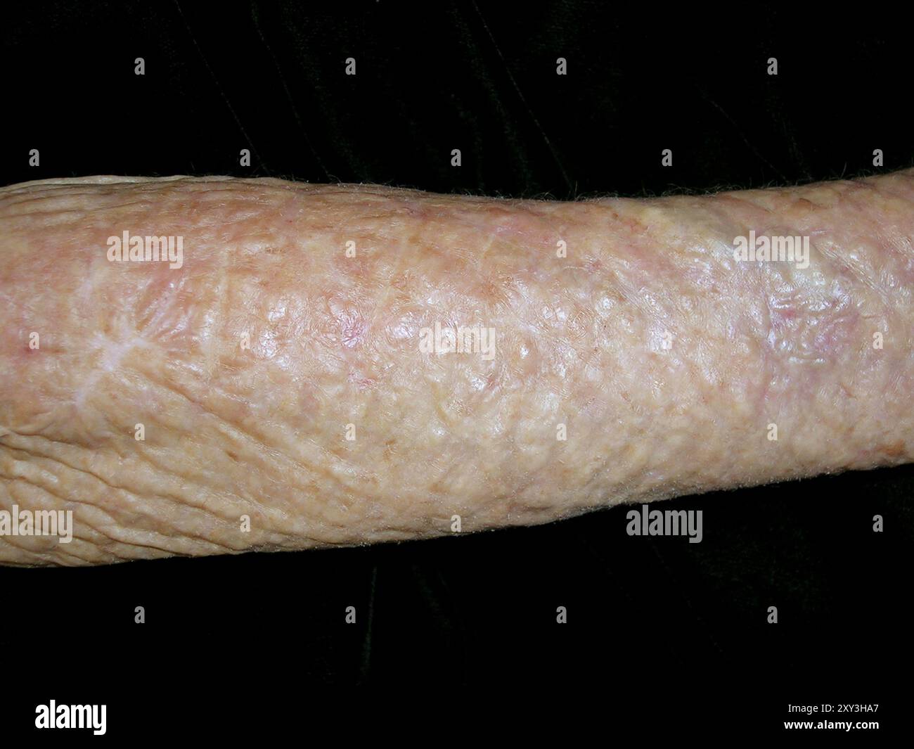 Actinic keratosis on the arm of a 67 year old patient following ...