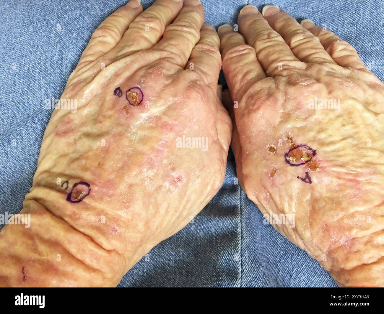 Actinic keratosis on the hands of a 67 year old patient following ...