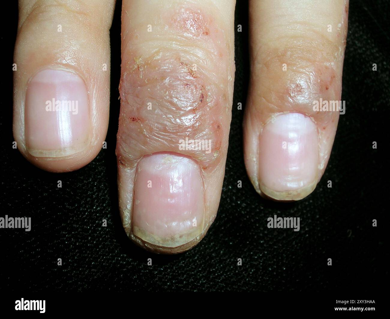 Atopic dermatitis on a 10 year old Asian boy's fingers and nails ...