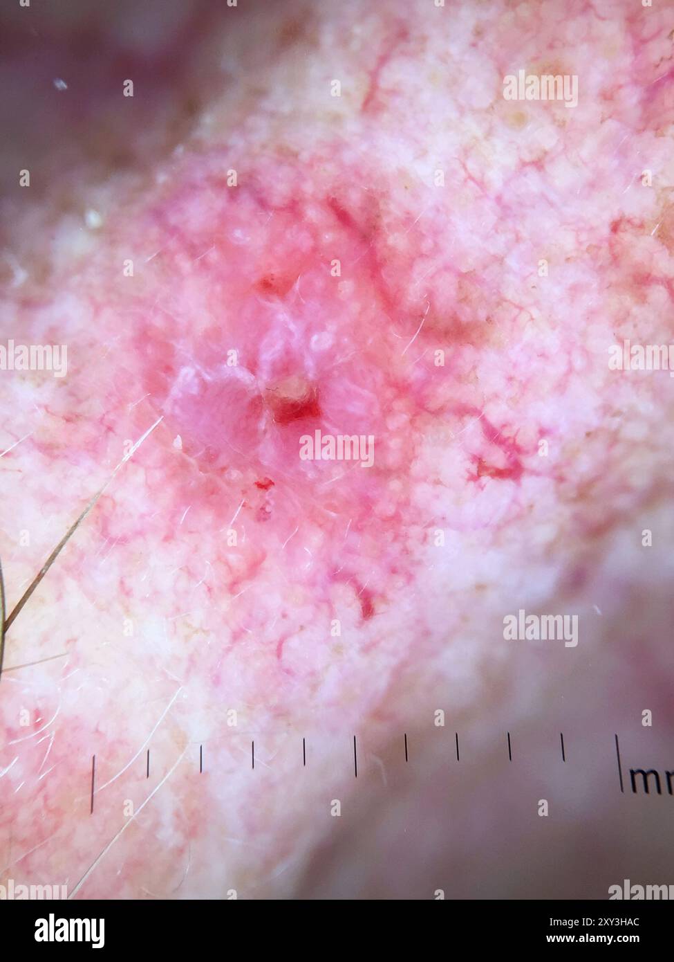 Dermatoscope image of actinic keratosis on the skin of a 67 year old ...