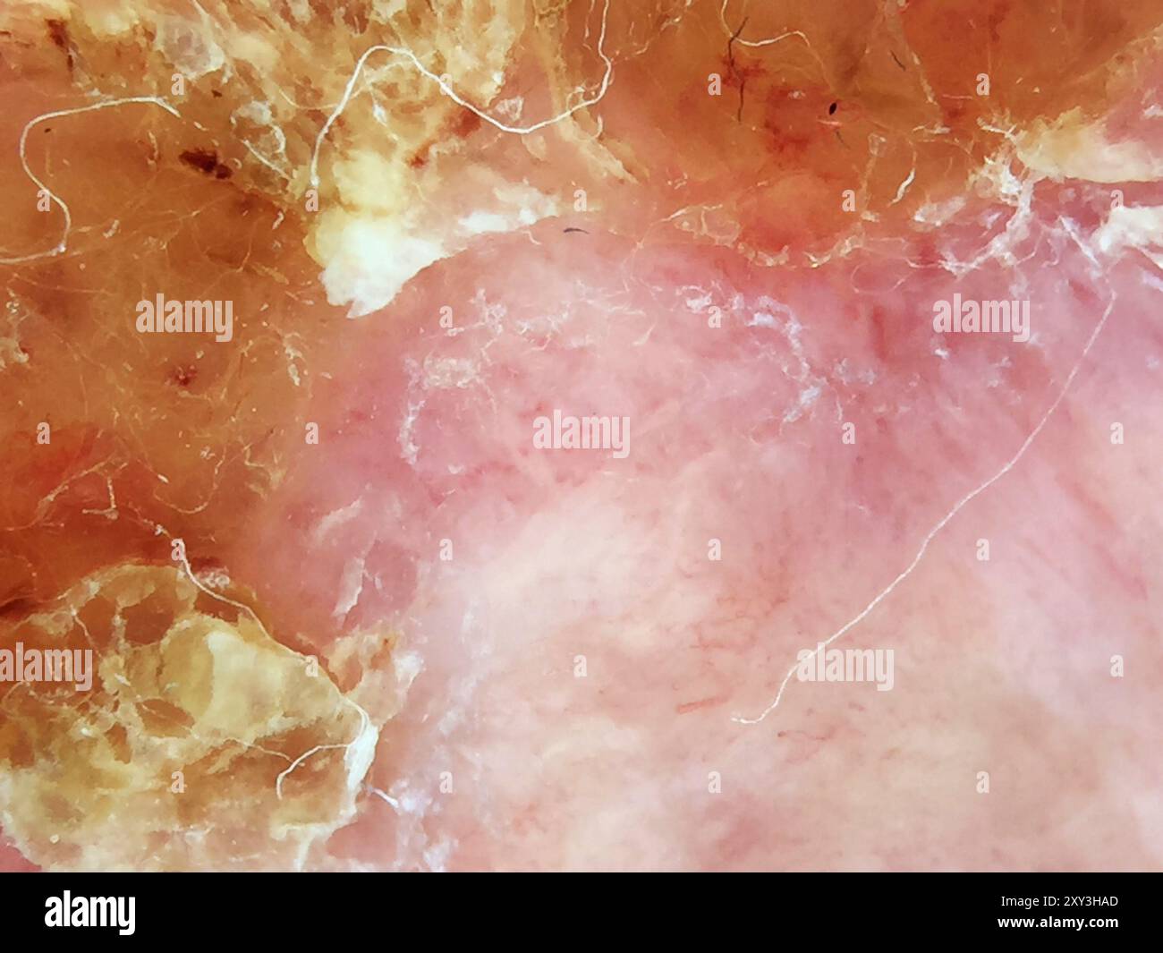 Dermatoscope image of actinic keratosis on the skin of a 67 year old ...