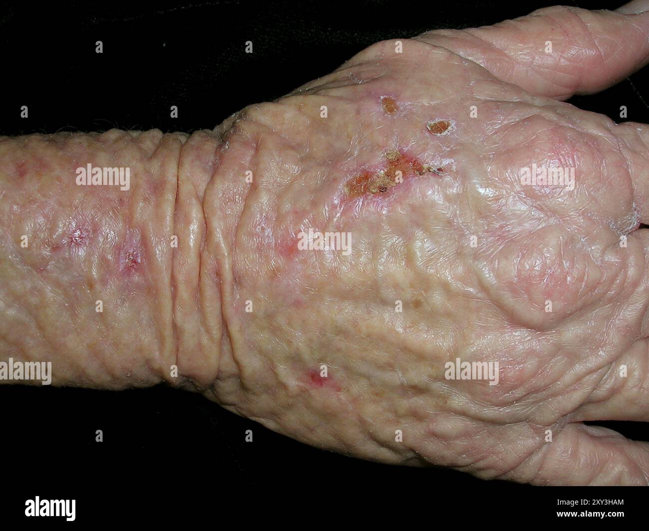 Actinic keratosis on the hand of a 67 year old patient following ...