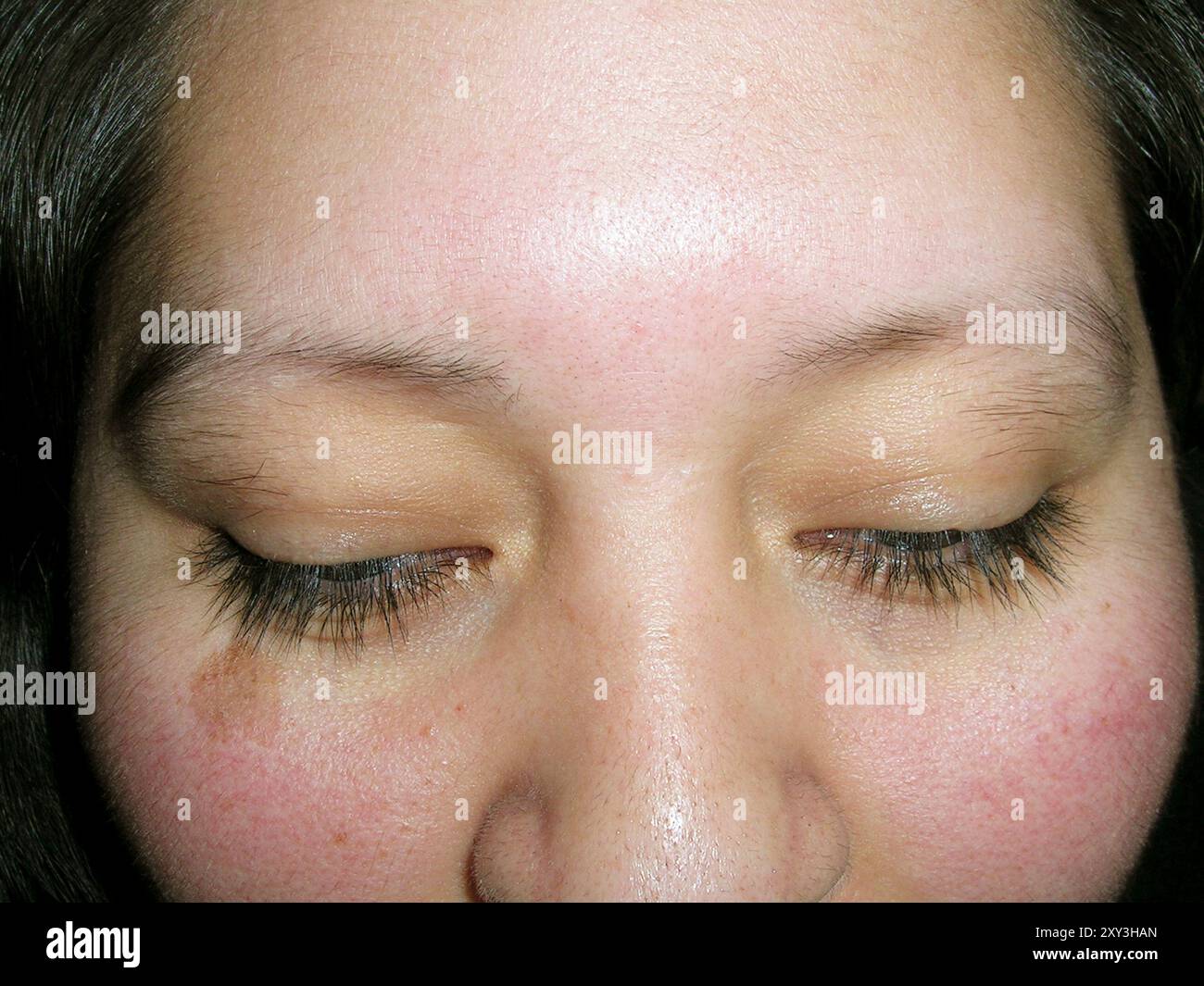 Bald spots in the eyebrows of a 26 year old Hispanic female patient ...