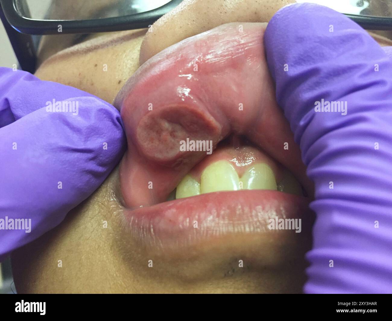 Aphthous Ulcer On The Inside A 32 Year Old Mans Upper Lip An Aphthous