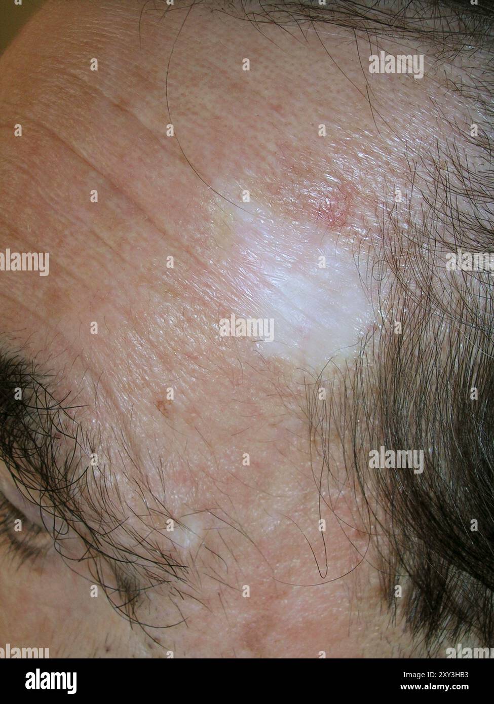 Actinic keratosis on a patient's forehead. This is a precancerous skin ...