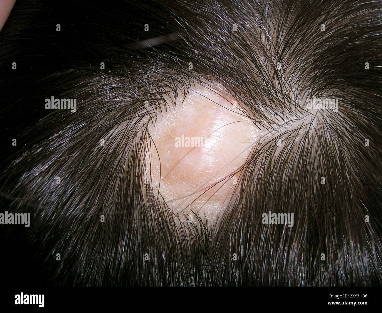 Bald patch on the scalp of a child due to aplasia cutis congenita (ACC ...