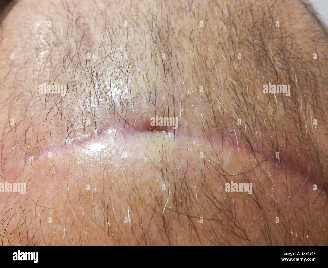 Head scar hi-res stock photography and images - Alamy