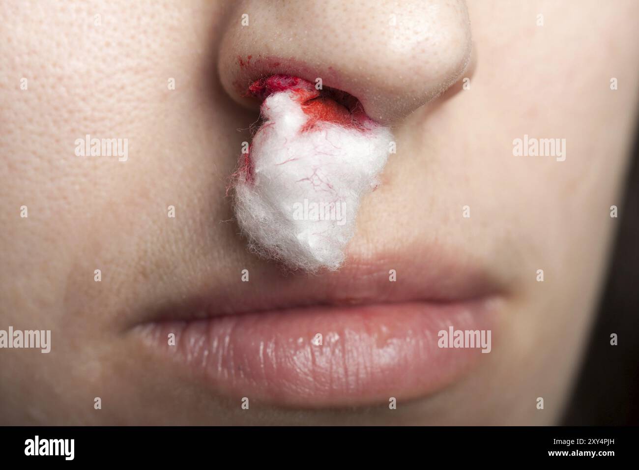 Wound nosebleed, adult human nose injury blood Stock Photo - Alamy