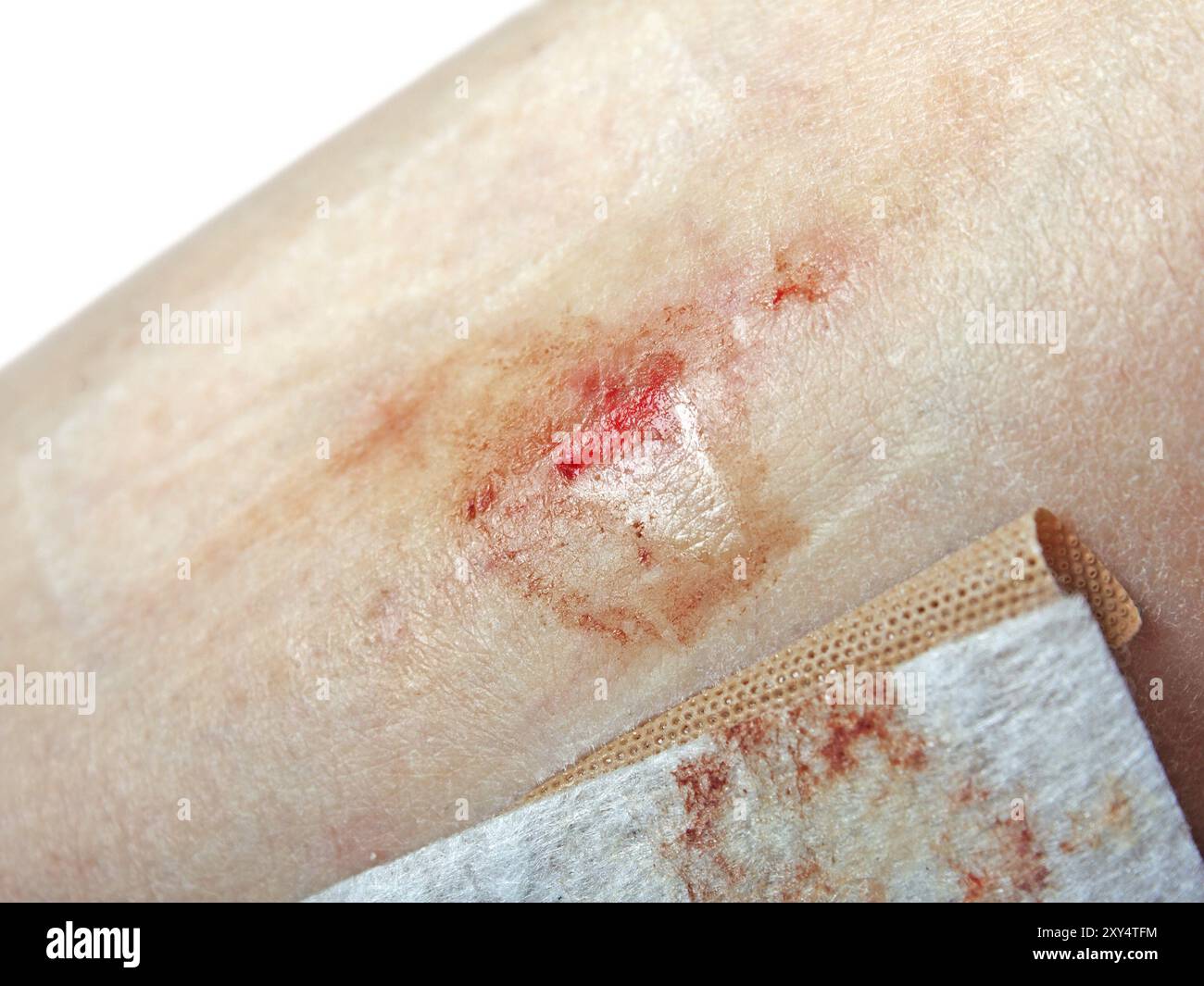 Physical human injury wound medicine healthcare Stock Photo - Alamy