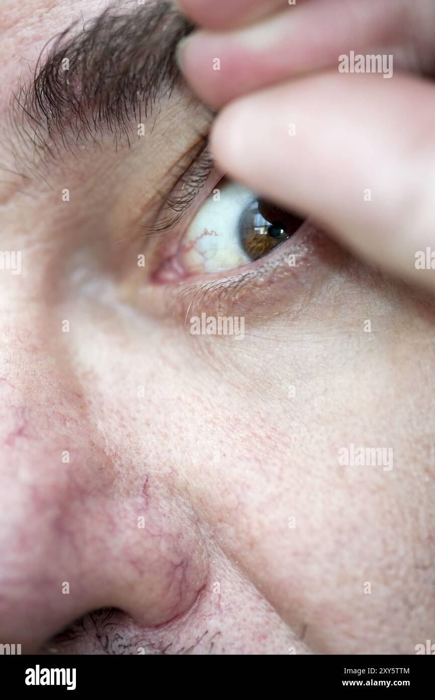 Eyelid pull hi-res stock photography and images - Alamy
