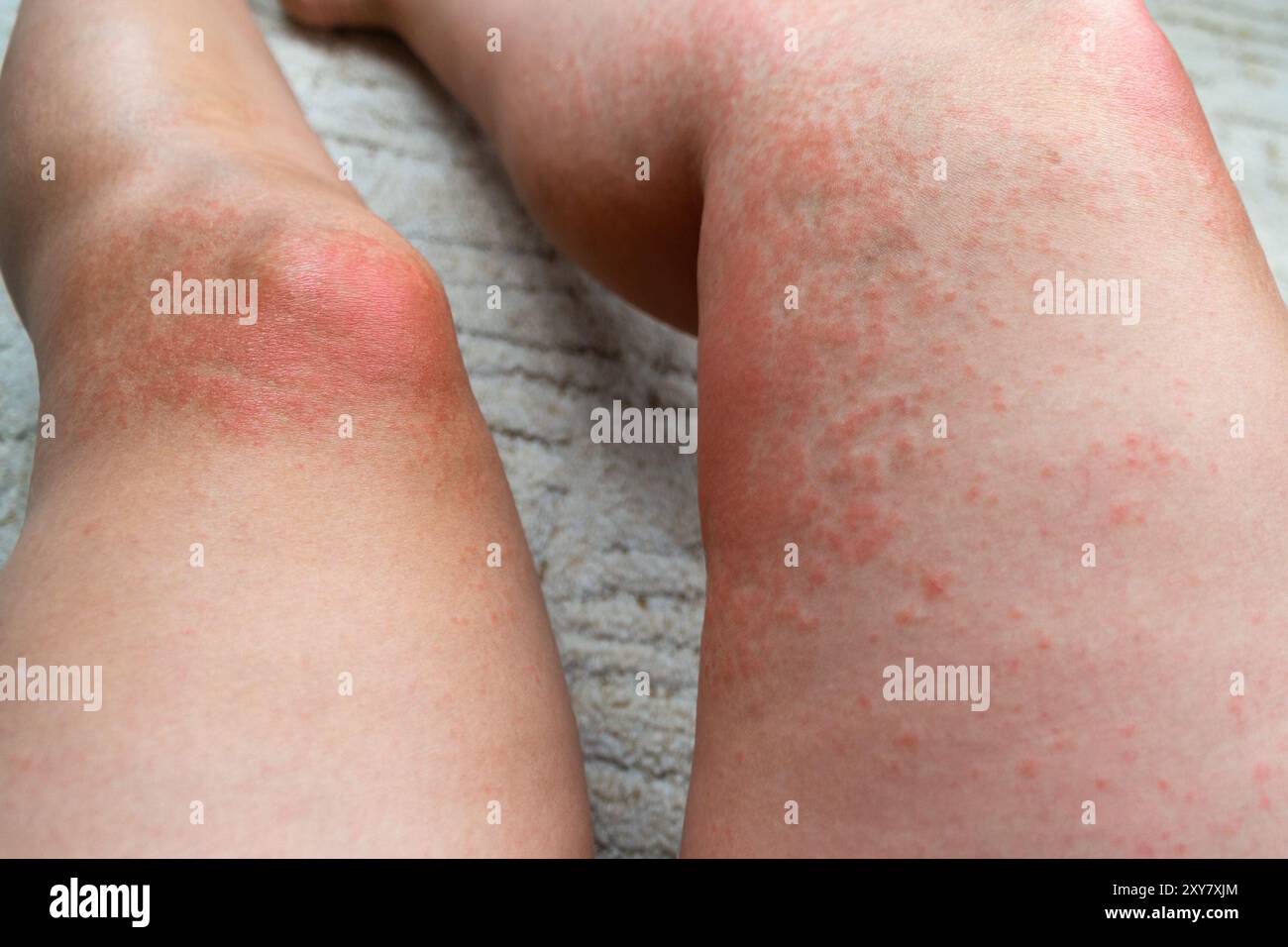 Allergic rash on the leg. Photodermatitis. Allergy to the sun ...