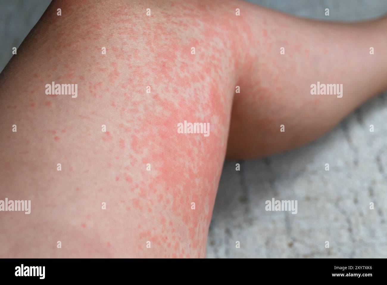 Allergic rash on the leg. Photodermatitis. Allergy to the sun ...