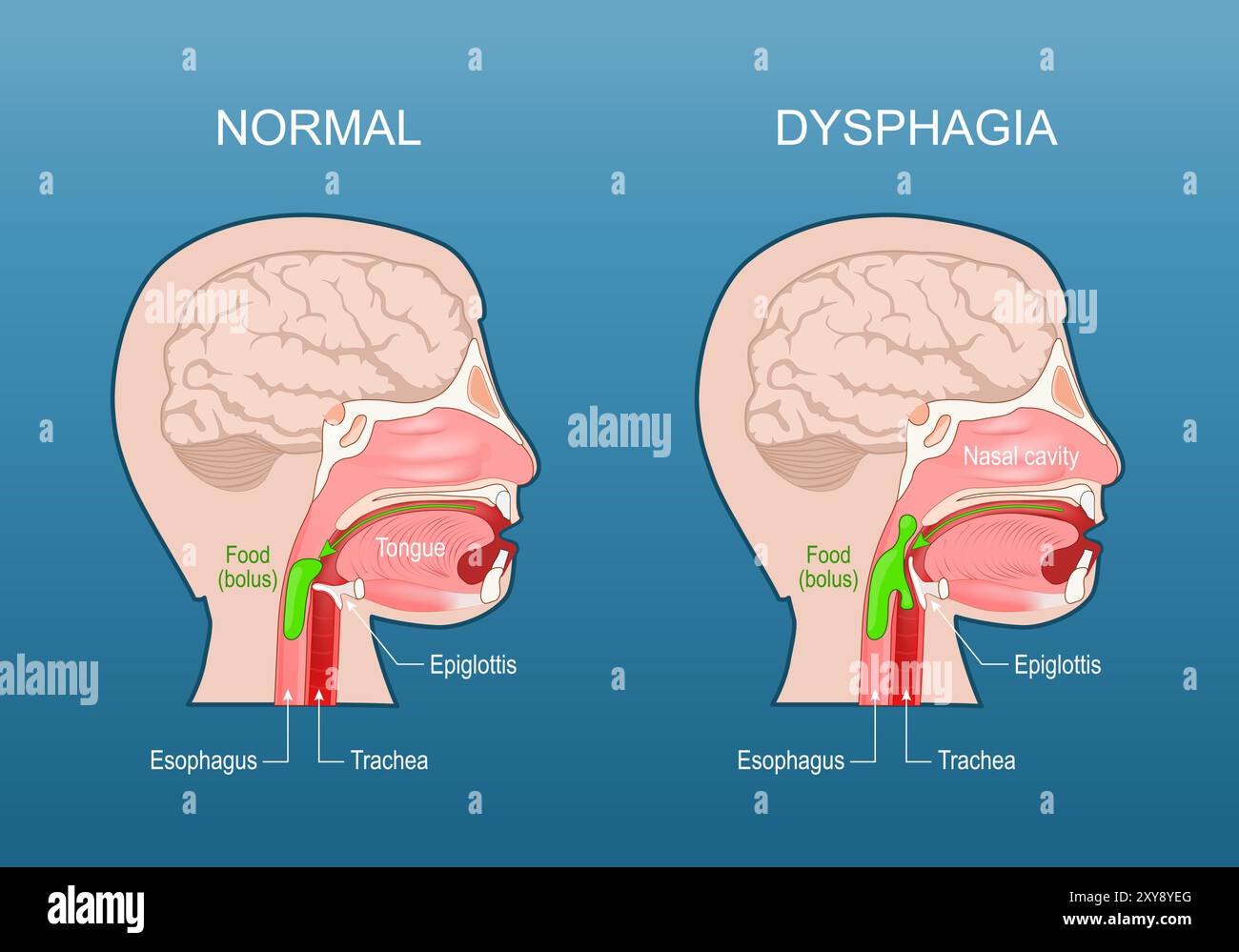 Dysphagia. Swallowing difficulty. Esophageal dysphagia. Aspiration risk ... Dysphagia. Swallowing difficulty. Esophageal dysphagia. Aspiration risk ...