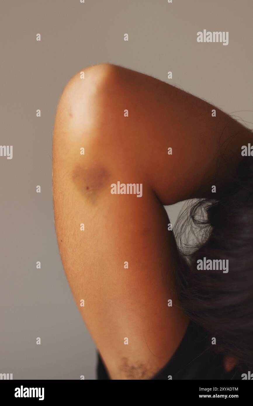 A heart-shaped bruise on the arm of a young woman symbolizes the pain ...
