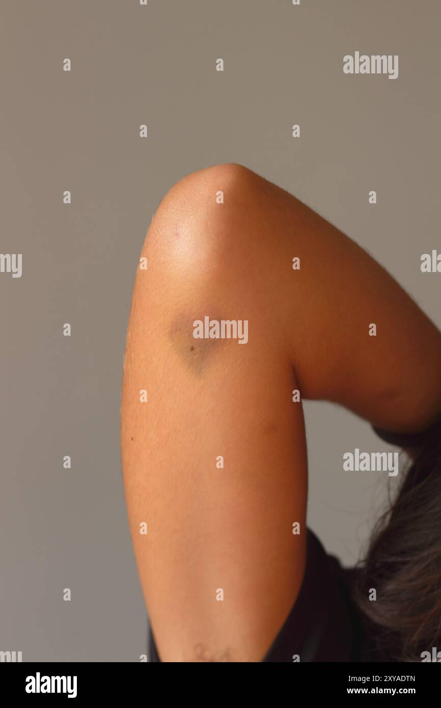 A heart-shaped bruise on the arm of a young woman symbolizes the pain ...