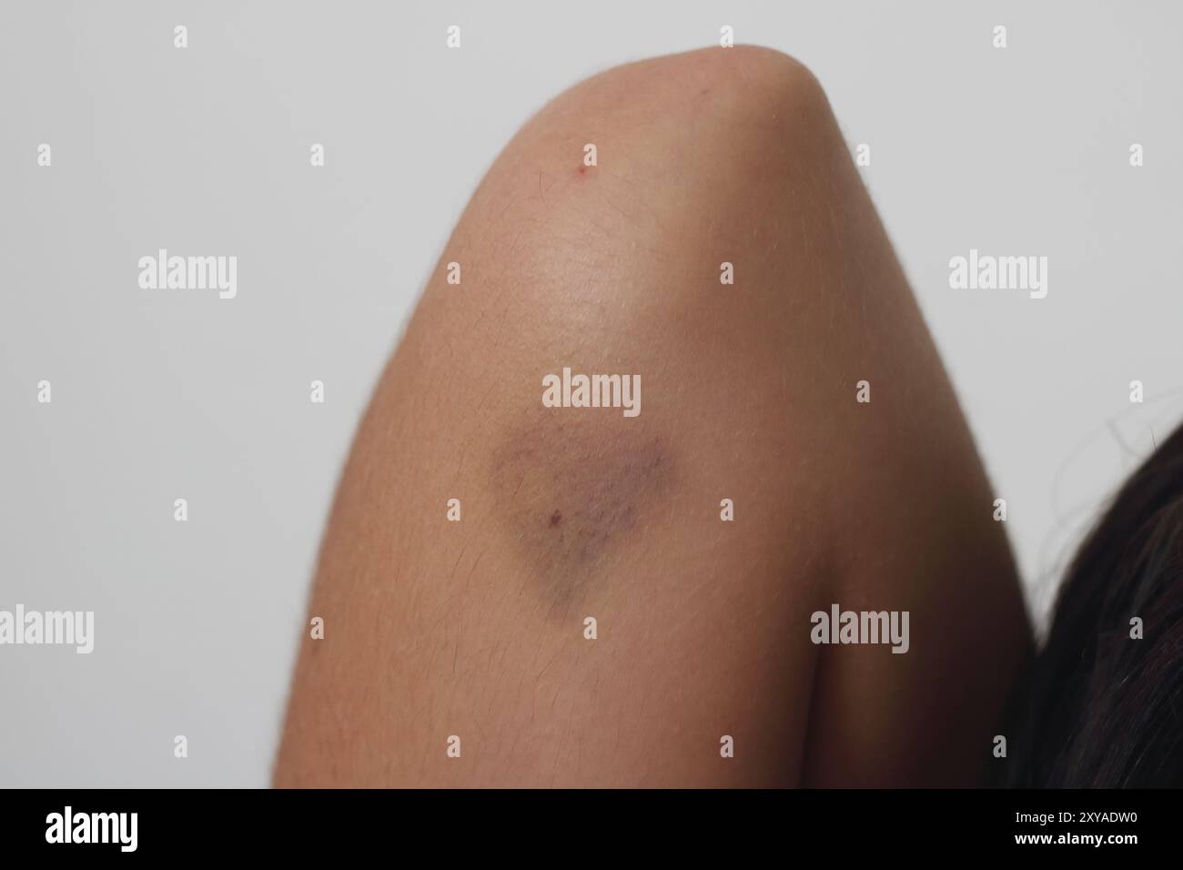 Scars arm hi-res stock photography and images - Alamy