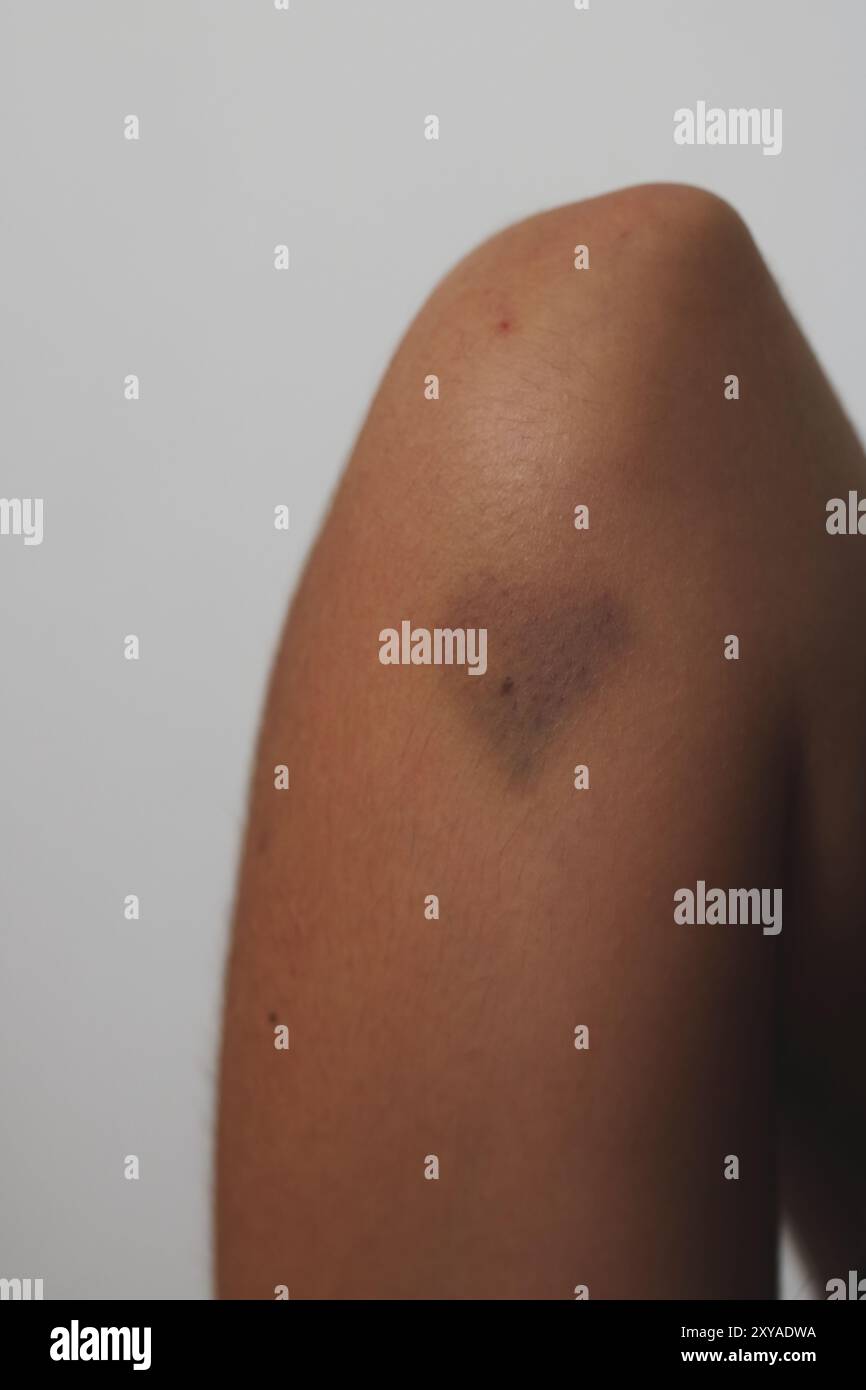 A heart-shaped bruise on the arm of a young woman symbolizes the pain ...