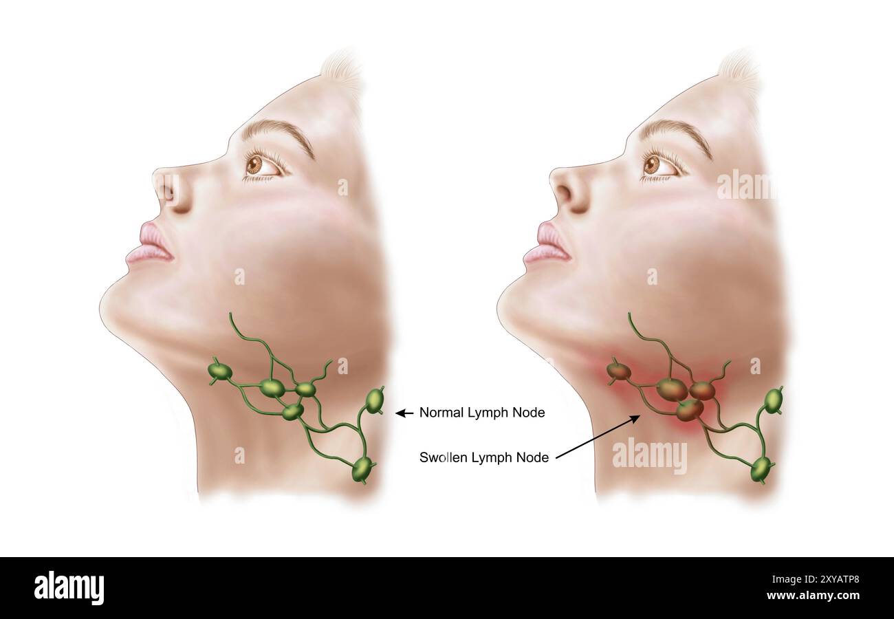Swollen lymph nodes hi-res stock photography and images - Alamy