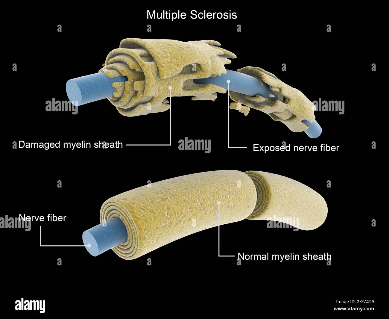 Multiple sclerosis neuron compared to a normal neuron Stock Photo - Alamy Multiple sclerosis neuron compared to a normal neuron Stock Photo - Alamy