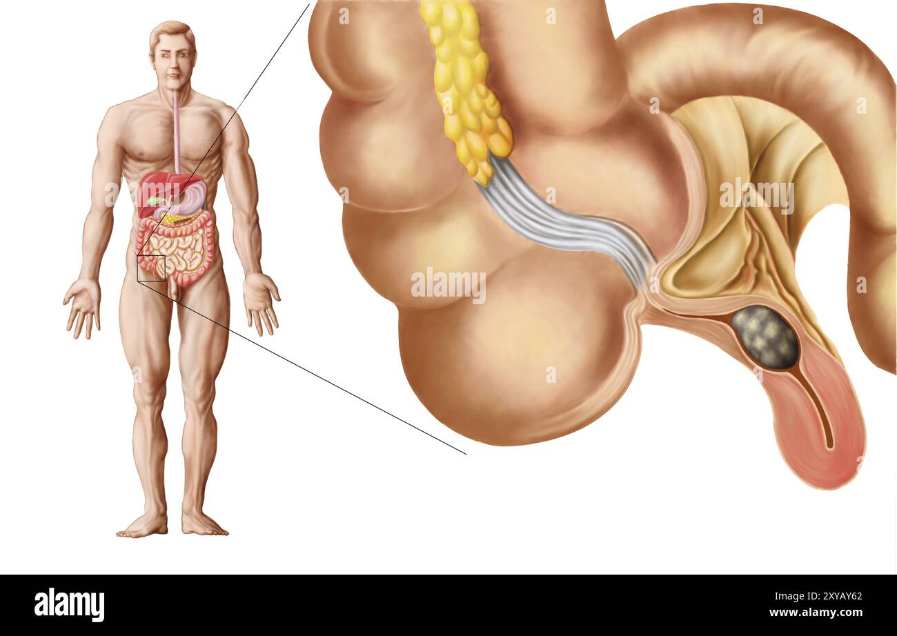Appendicitis male hi-res stock photography and images - Alamy