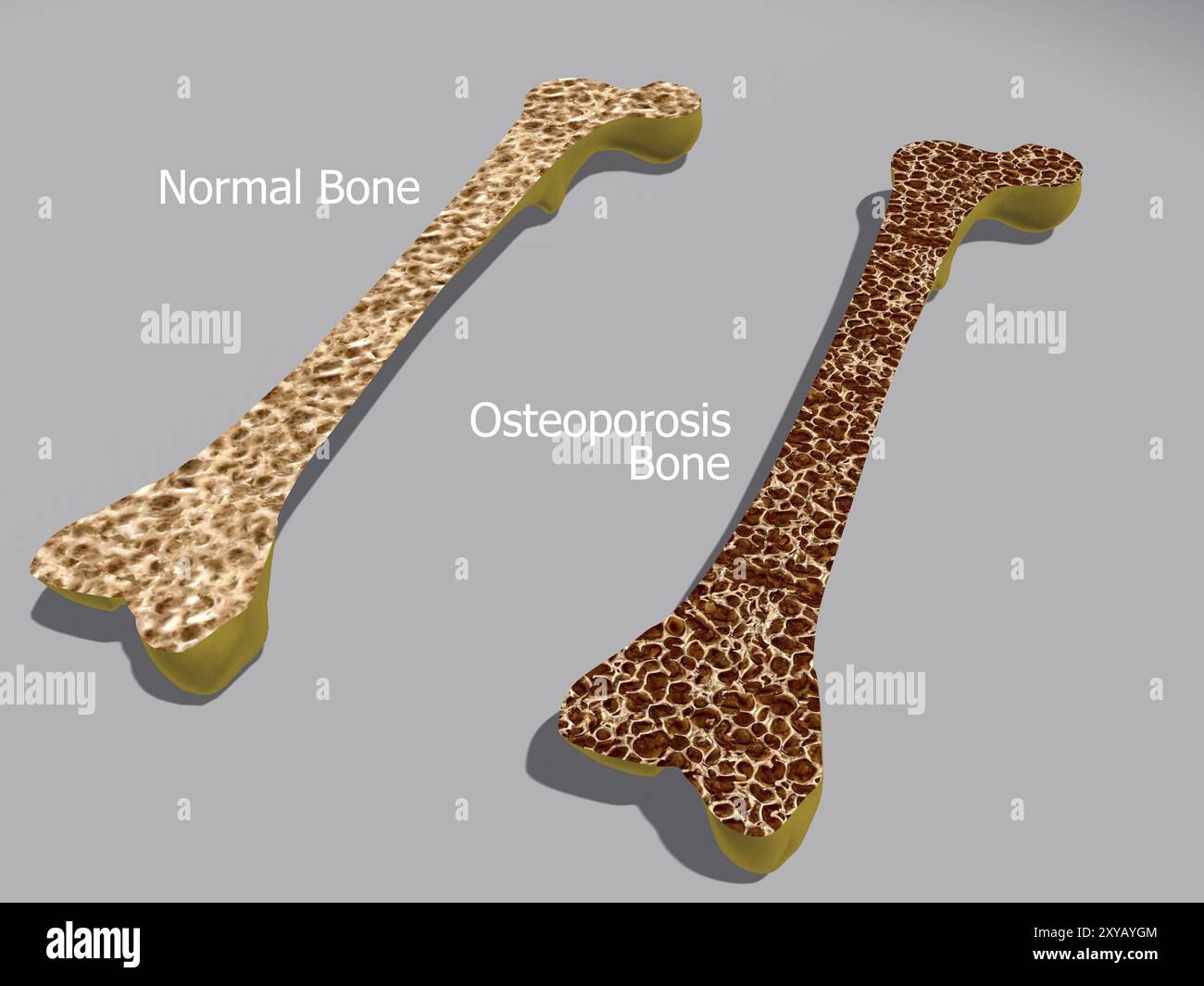 Comparison of a healthy bone and a bone with osteoporosis. Osteoporosis ...