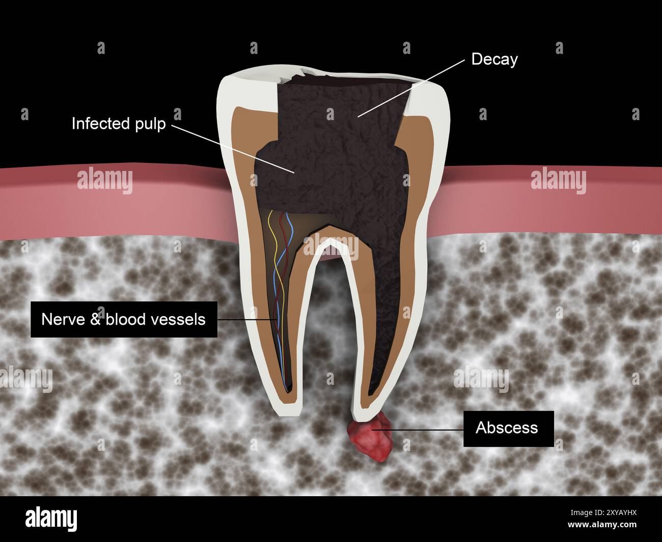 Cutaway view of a tooth cavity Stock Photo - Alamy