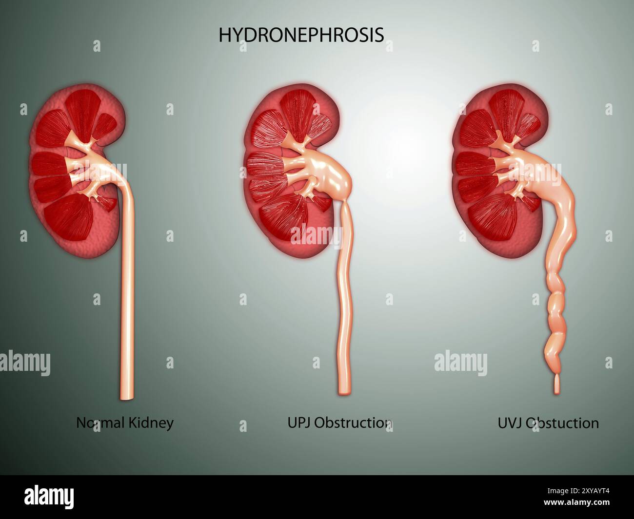 Hydronephrosis is a condition that typically occurs when one kidney ...