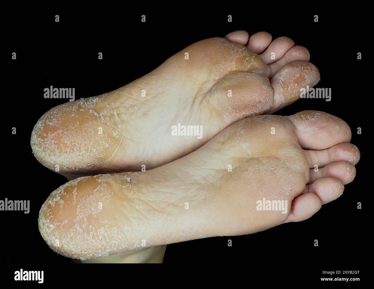 Skin peeling off from both feet side by side, on adult person Stock ...