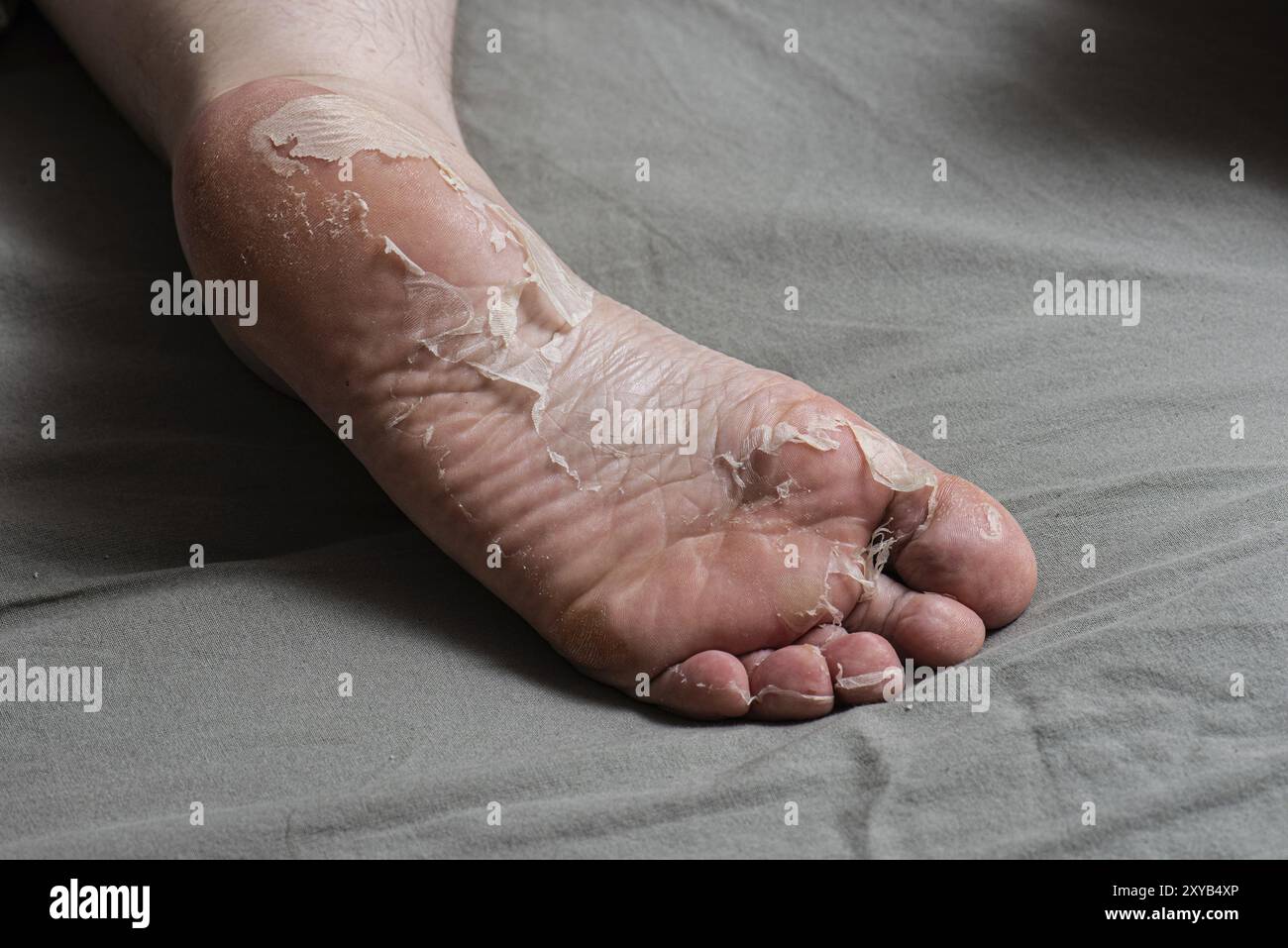 Skin peeling off a foot Stock Photo - Alamy