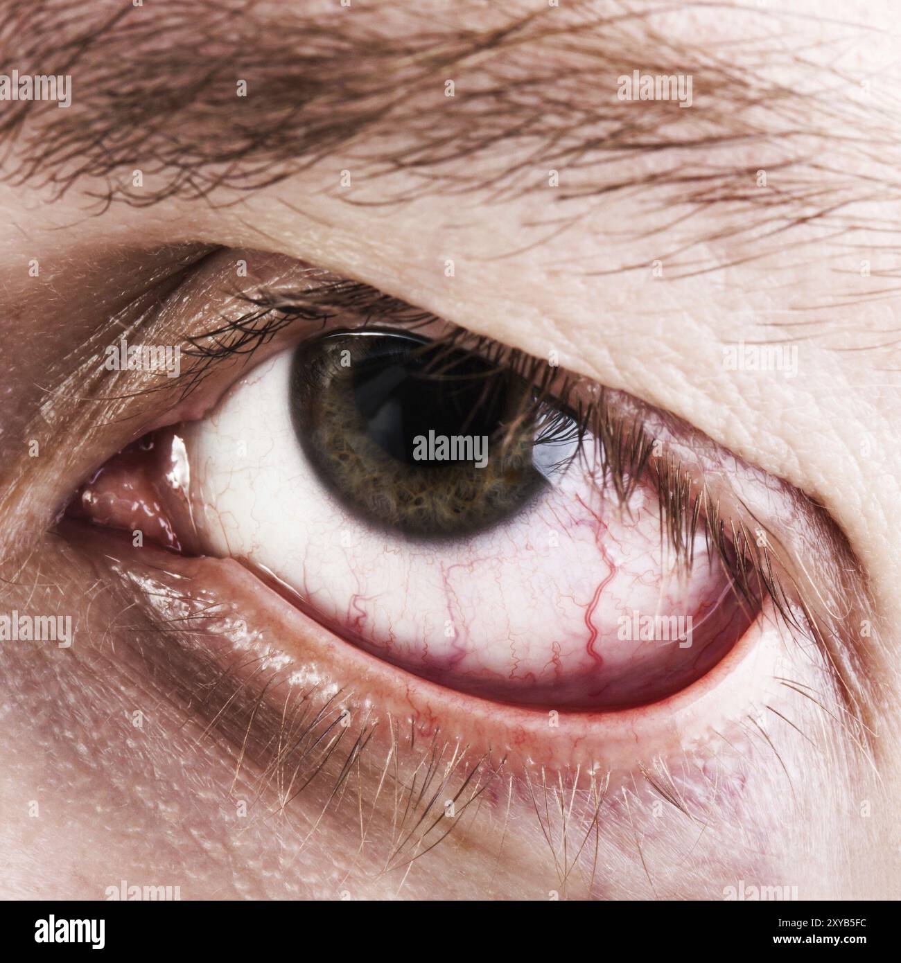 Medicine healthcare blood capillary human eye pain Stock Photo - Alamy
