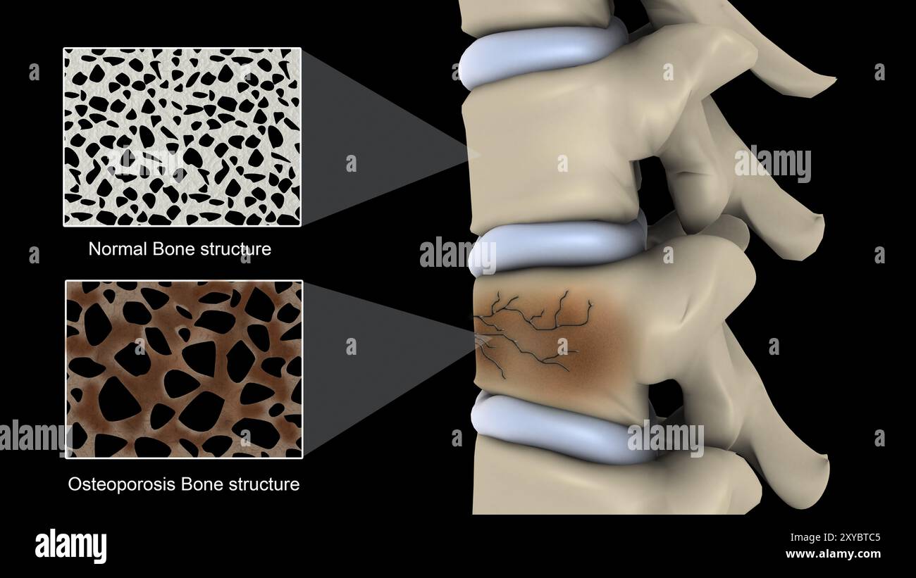Microscopic structure of bone hi-res stock photography and images - Alamy