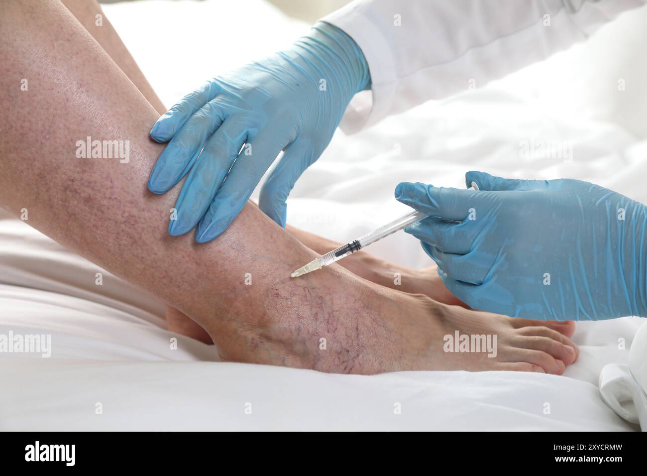Varicose veins treatment. Doctor giving injection to patient indoors ...