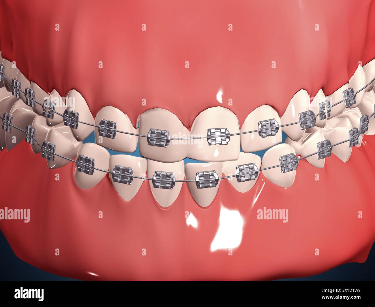 Medical illustration of human mouth showing teeth, gums and metal ...