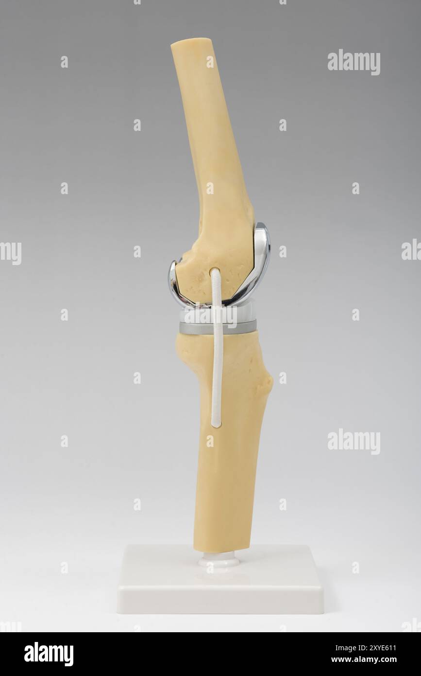 Artificial knee joint Stock Photo - Alamy