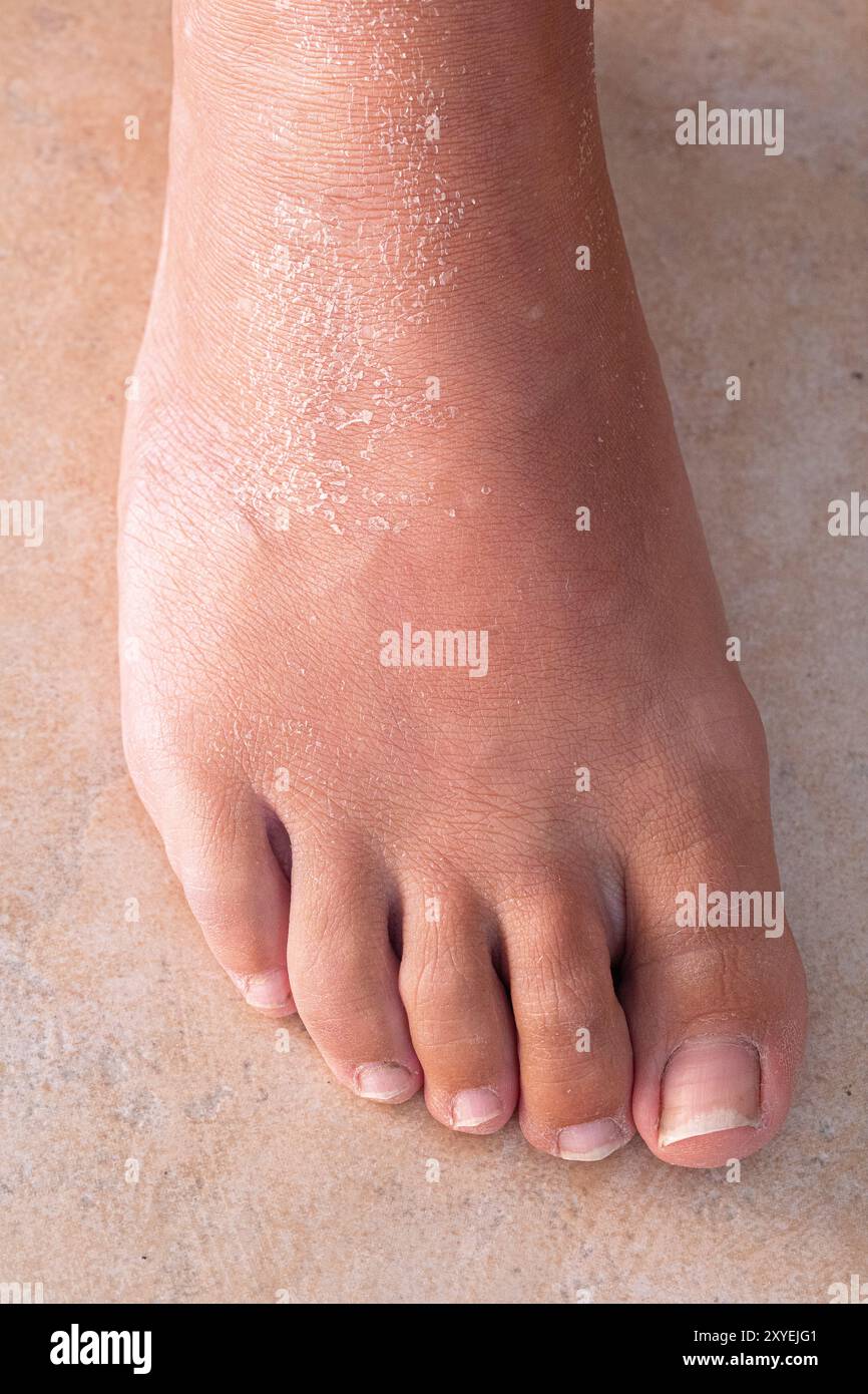 Close-up view of a foot with dry, flaky skin, highlighting a potential ...