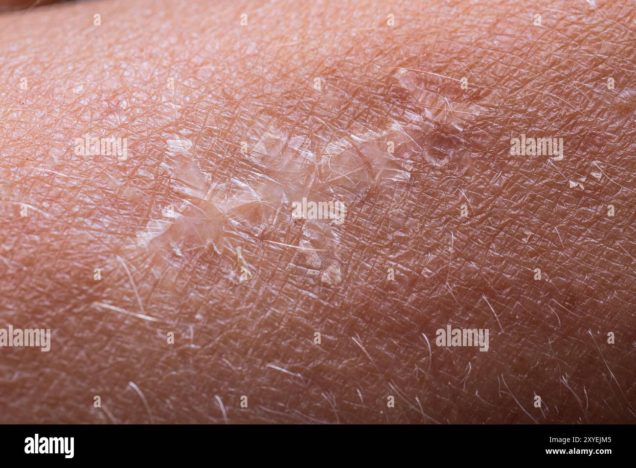 Possible skin irritation hi-res stock photography and images - Alamy