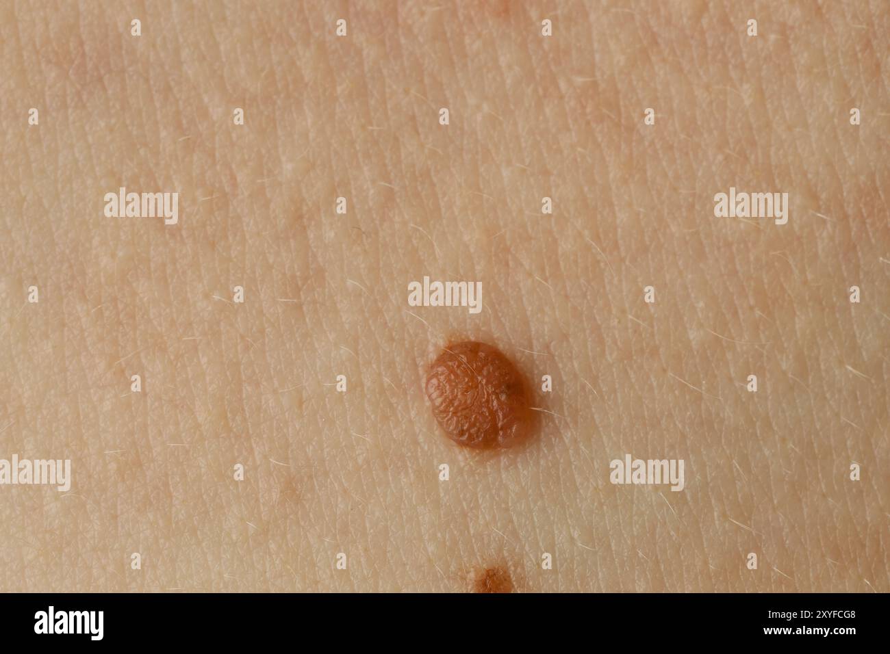 Benign nevus skin dermatology hi-res stock photography and images - Alamy