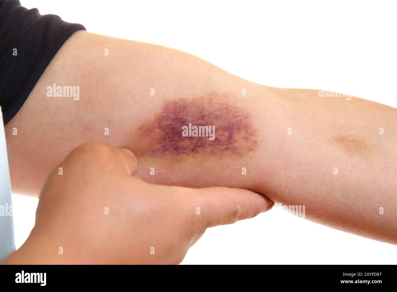 Hematoma arm hi-res stock photography and images - Alamy