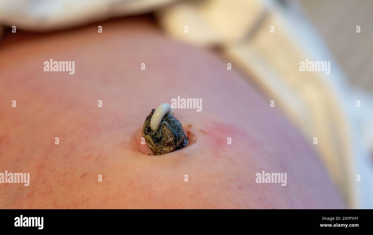 An infants umbilical cord stump is carefully cleaned with a cotton swab ...