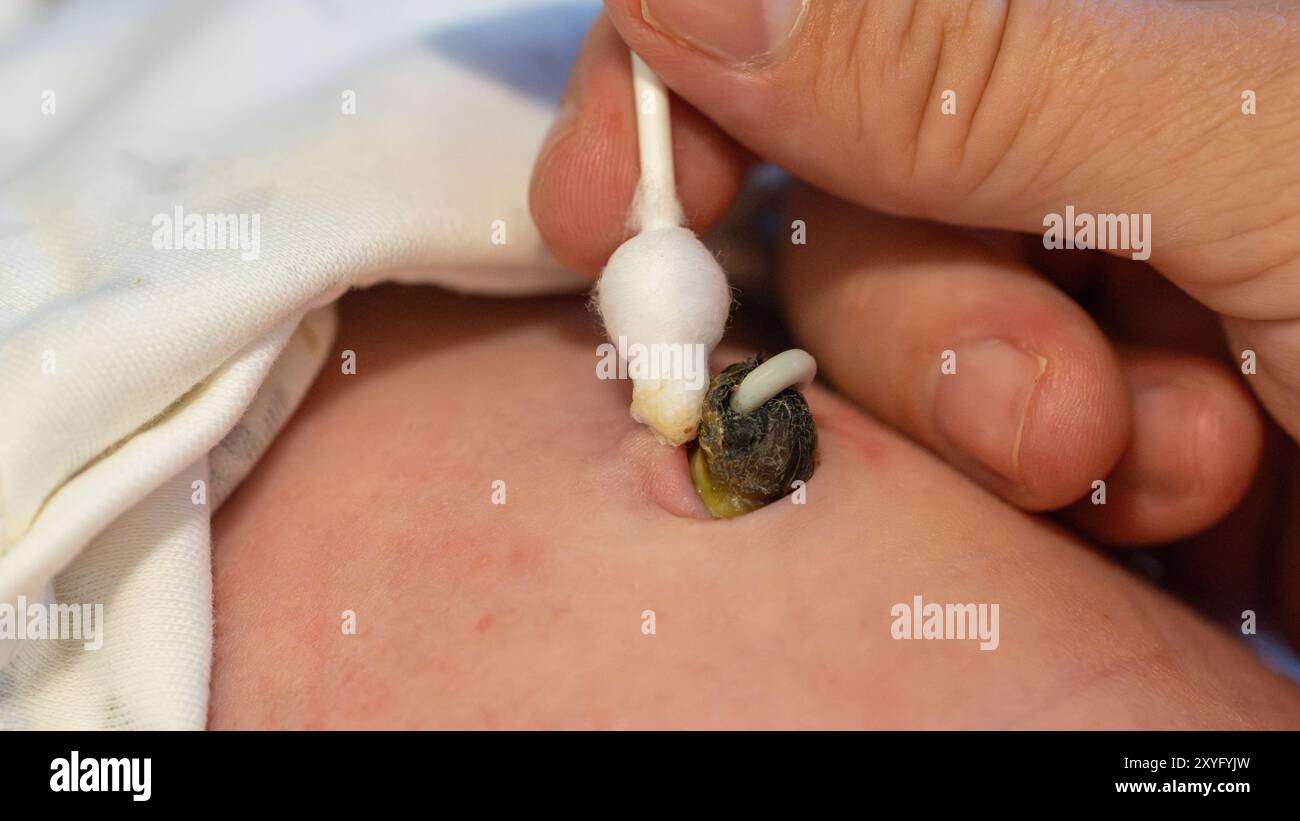 An infants umbilical cord stump is carefully cleaned with a cotton swab ...