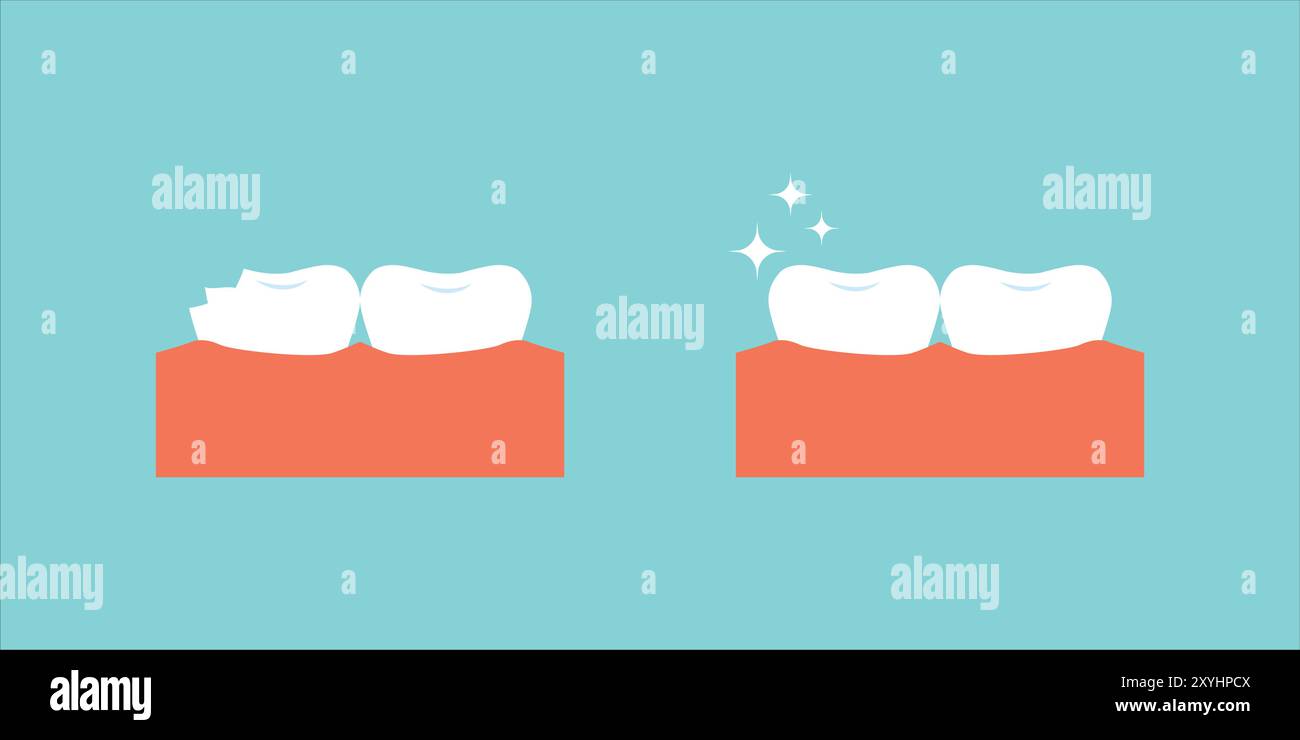 Injury chipped tooth and healthy tooth before, after treatment icon set ...