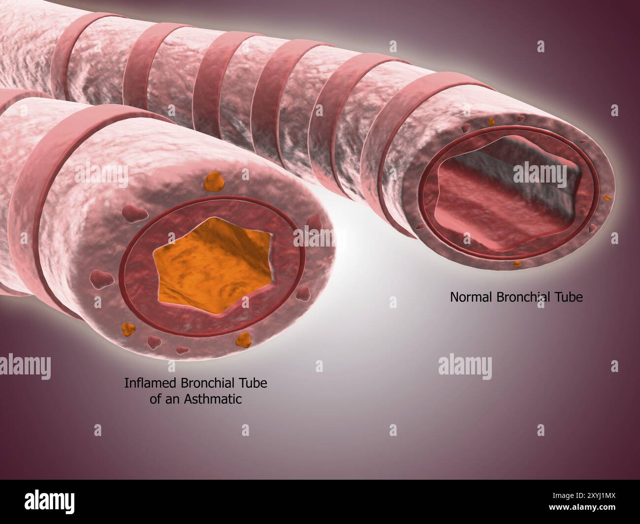 Trachea cross-section showing comparison of normal and asthmatic ...