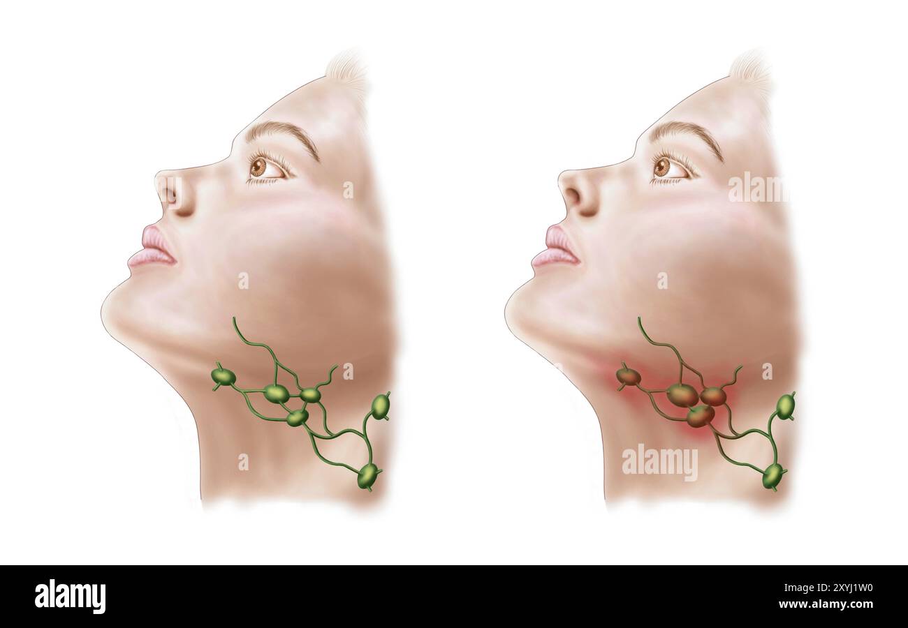 Swollen lymph nodes hi-res stock photography and images - Alamy