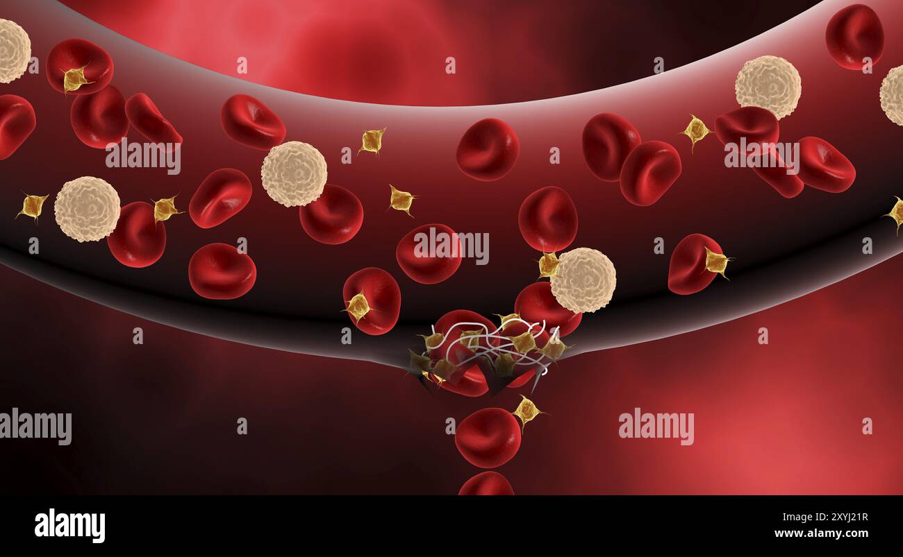 Blood clotting inside artery Stock Photo - Alamy
