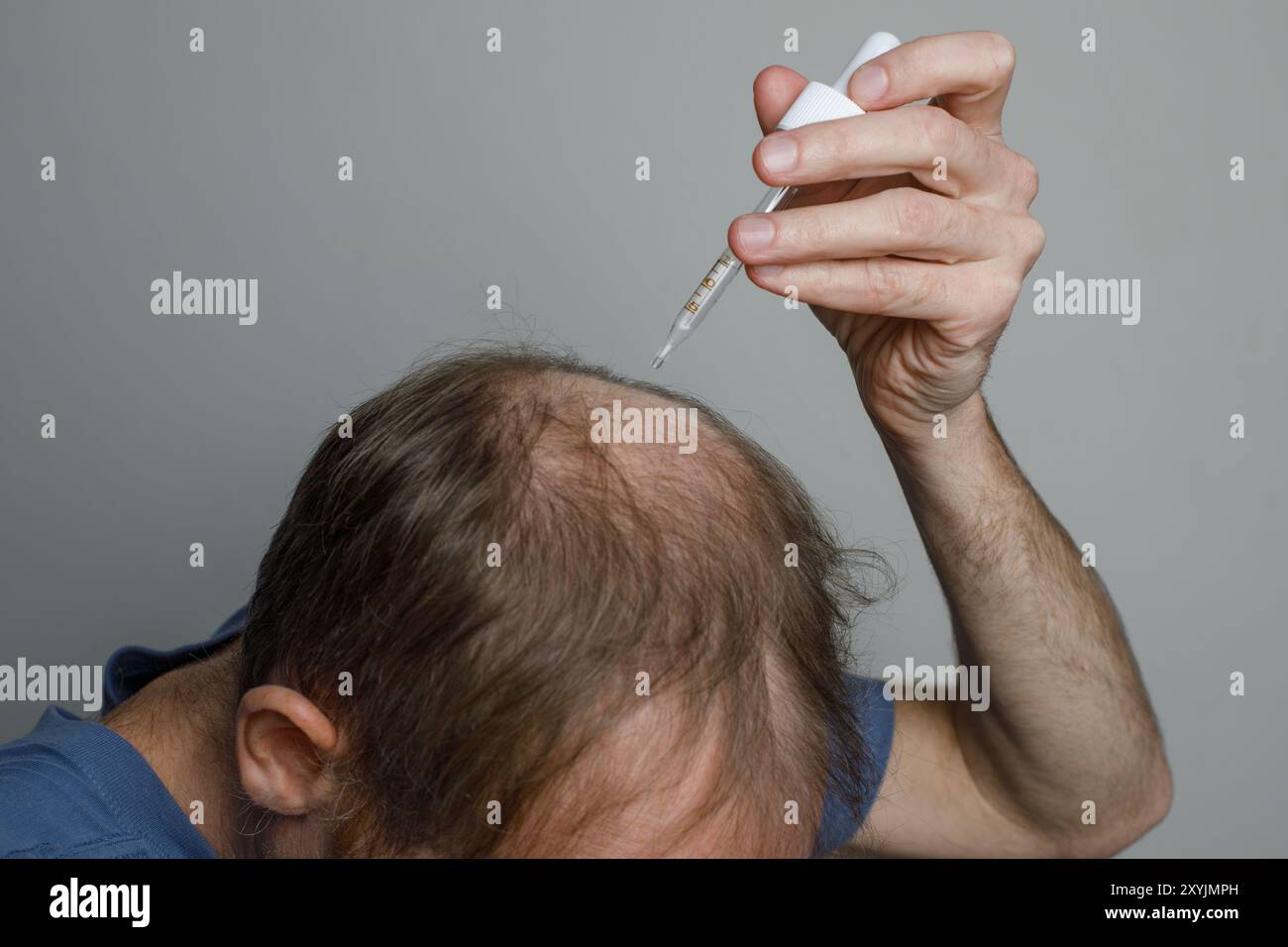 Mature man applying hair loss serum or minoxidil on bald scalp Stock ...
