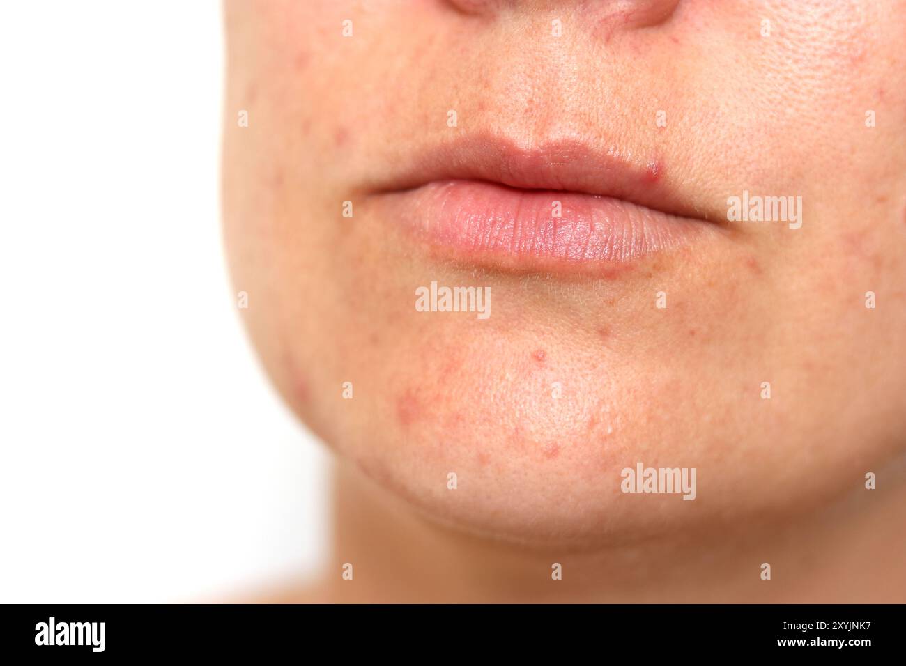 Close up of female face with red problematic acne skin and scars Stock ...