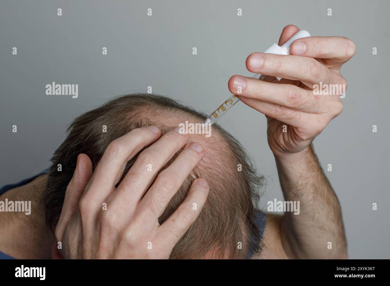 Balding man with baldness treatment. Male person applying dermatology ...