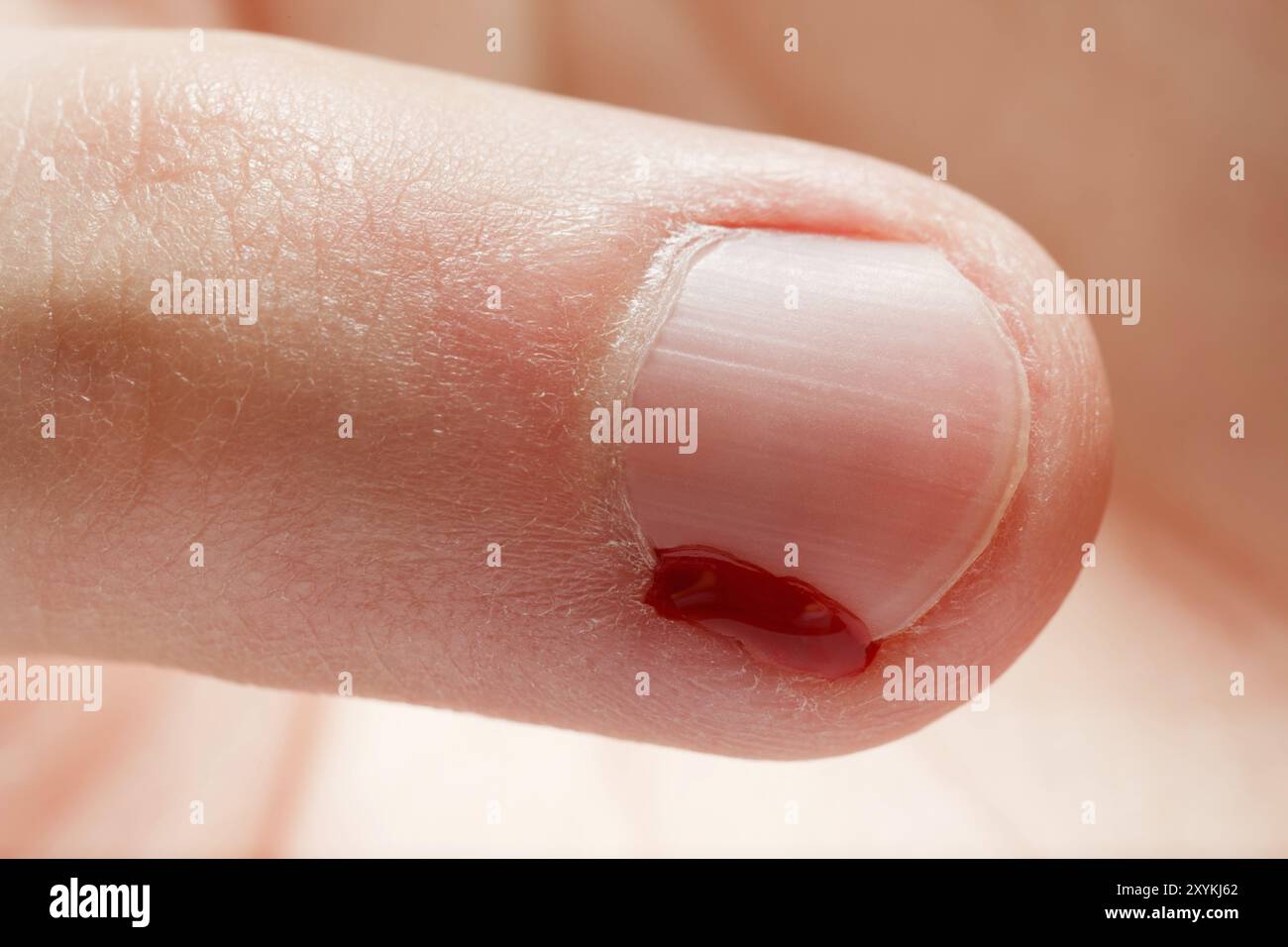 Physical injury blood wound human hand finger nail Stock Photo - Alamy