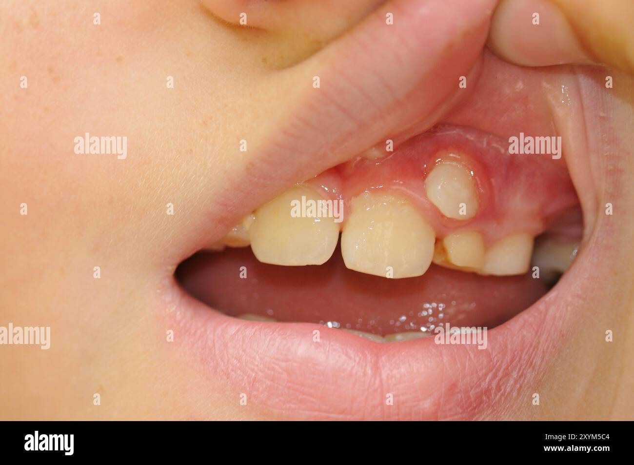 Teeth in the child's mouth open. Little child teeth mouth on face macro ...
