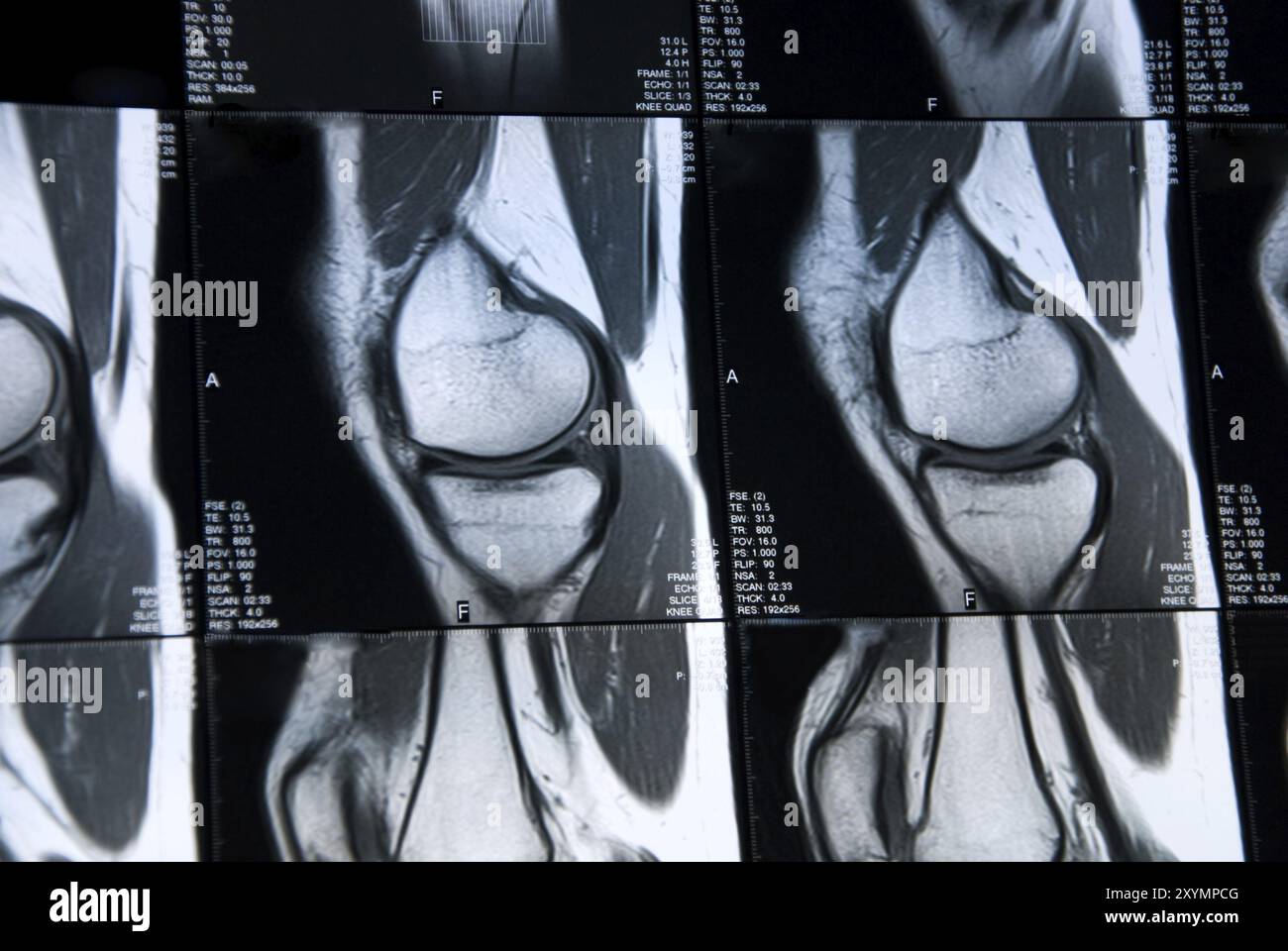 Mri knee hi-res stock photography and images - Alamy